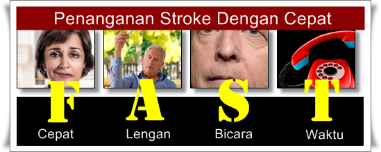 Tanda-Tanda Stroke Yang Sangat Penting Untuk Diketahui