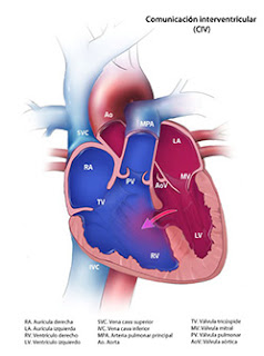 Shunt o Anastomosis: 2015