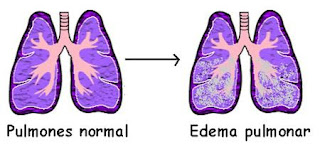 Que Es Un Edema Pulmonar: Síntomas, Causas y Tratamiento