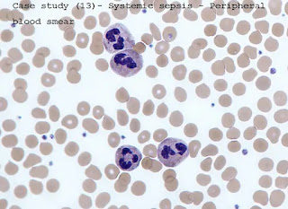 Case study (13)- Systemic sepsis and a mild macrocytic, normochromic anemia