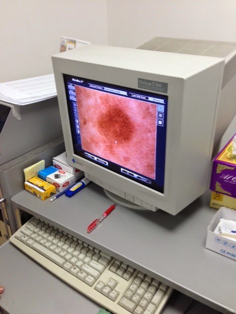 Come along for the ride!: Mole Mapping - how it works and why you ...