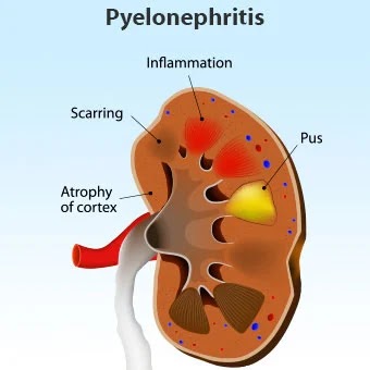Pyelonephritis- Causes, Symptoms, Treatment