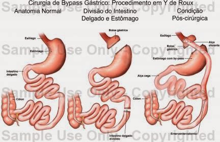 Vida de Uma Linda Borboleta: Minha cirurgia: Bypass Gástrico em Y de ...