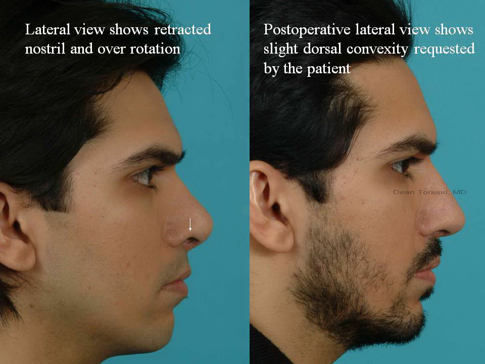 Dr. Dean Toriumi Reviews: Dean Toriumi Reviews: Nasal length restored ...