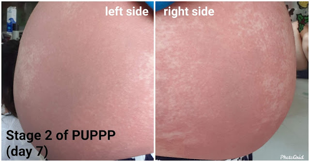 secondchance : PUPPP rash of pregnancy - What worked for me