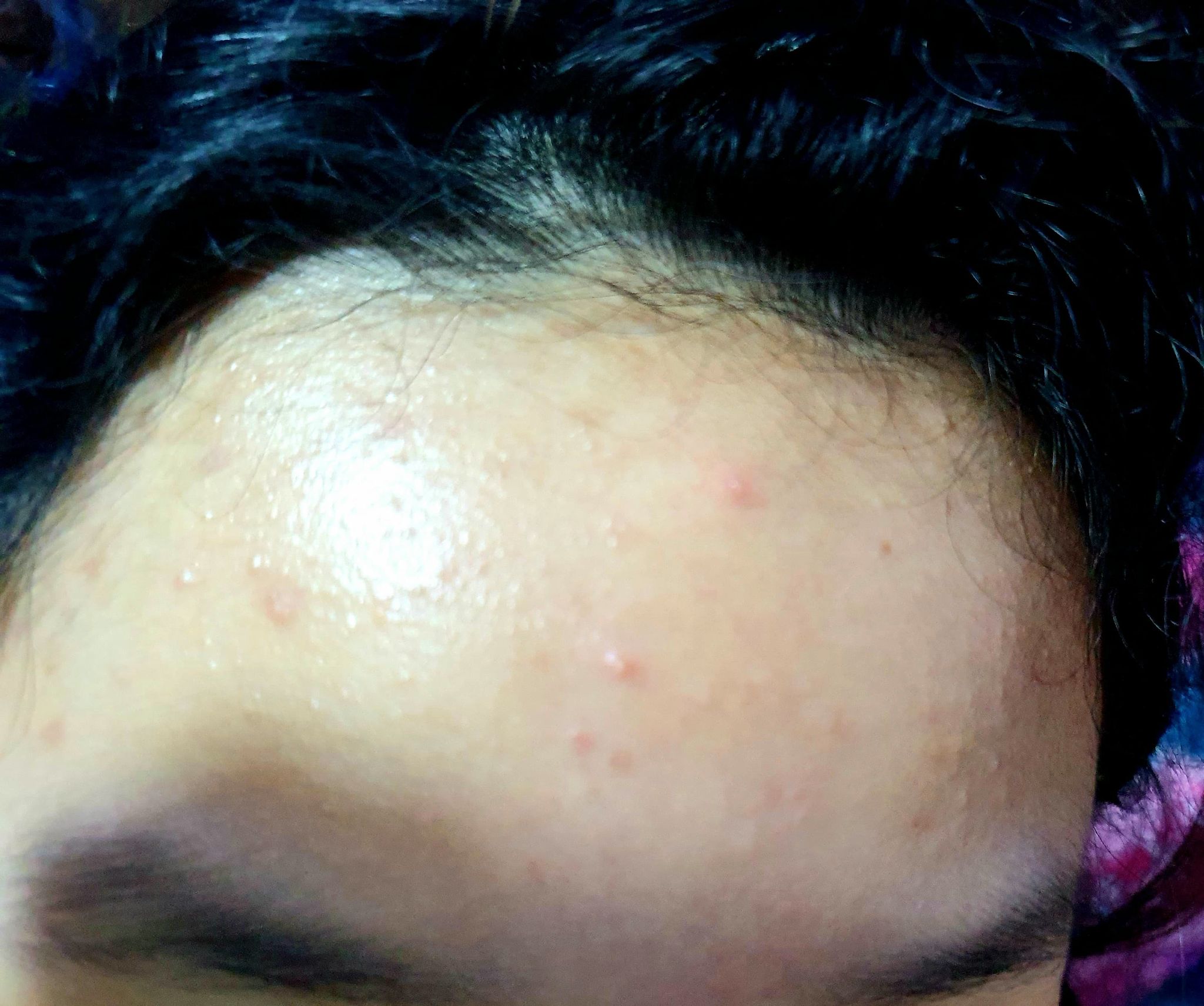 Pre-teen Acne: 10 years old Already Have Acne, What is Acne, and Its ...