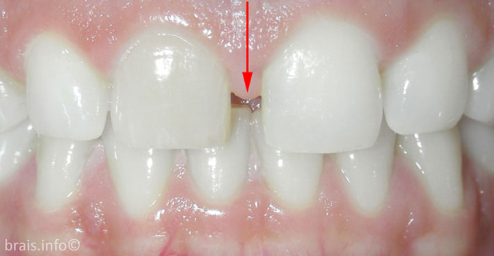 MESIODENS. CARACTERISTICAS.