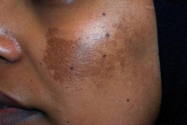 Melasma (Mask of Pregnancy): Symptoms, Diagnosis, and Treatments