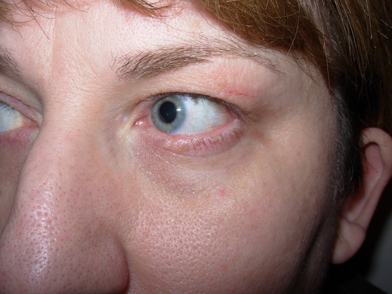 The Barber Bunch: Skin Cancer on my Eyelid