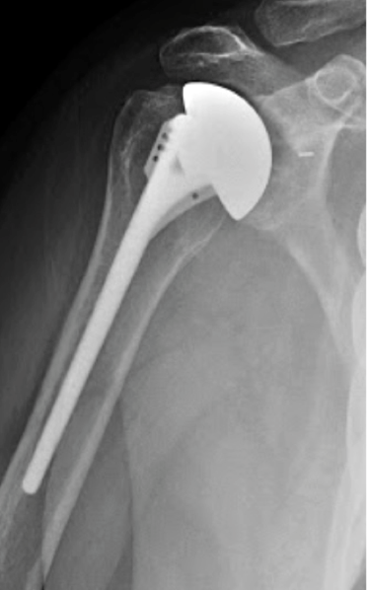 UW Shoulder and Elbow Academy: Are short stems of value in total ...