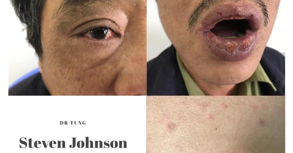 CASE LÂM SÀNG - ALLOPURINOL INDUCED SJS/TEN ~ Dr. Pham Tang Tung
