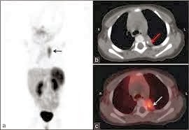 Medical Treatment Pictures-for Better Understanding: Opsoclonus ...