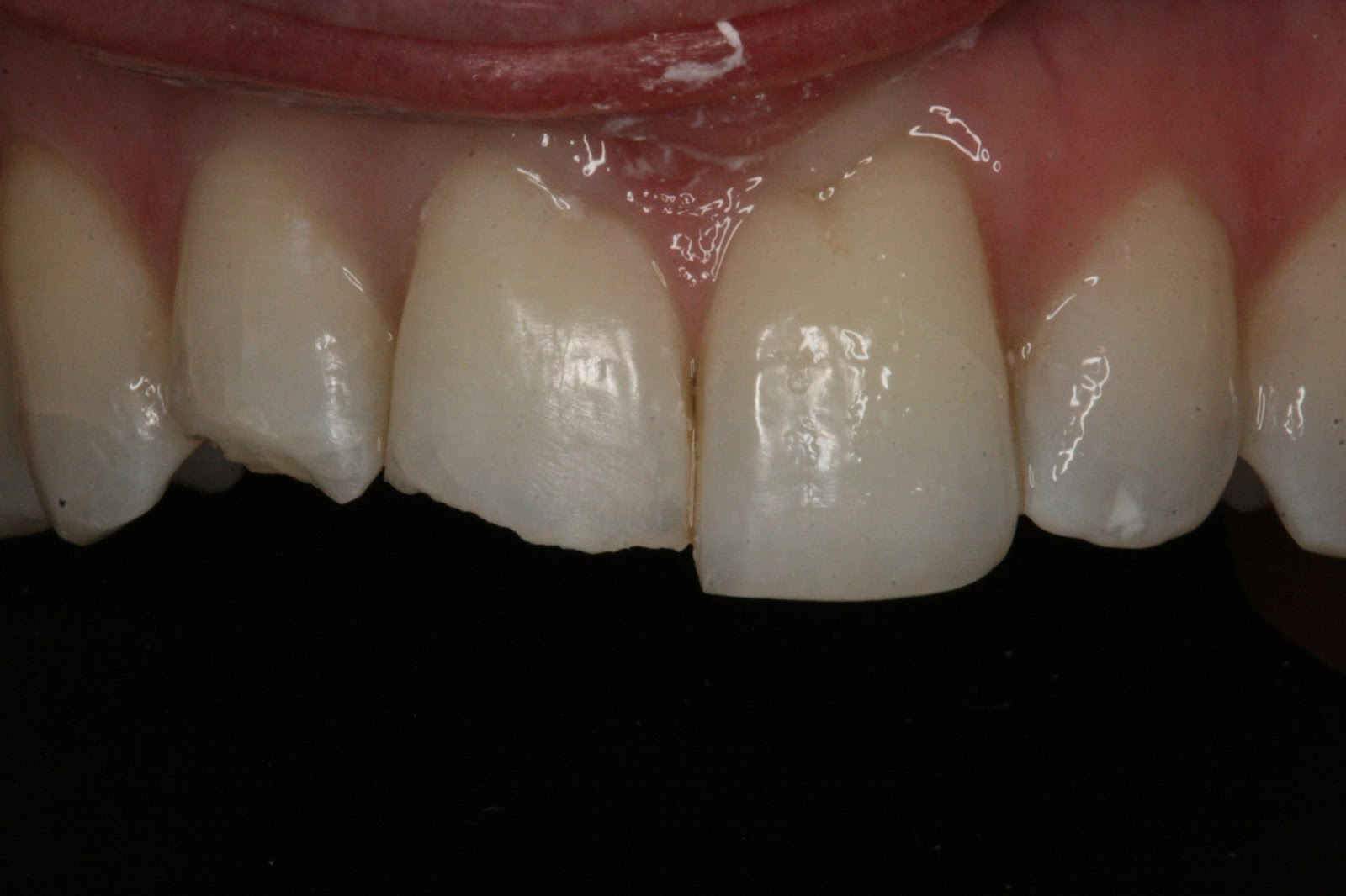 Dentistry To Talk About: Restoring Fractured Front Teeth