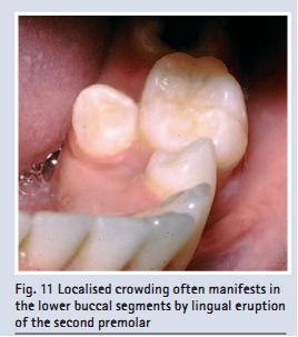 Dentistry lectures for MFDS/MJDF/NBDE/ORE: A NOTE ON- Extractions In ...