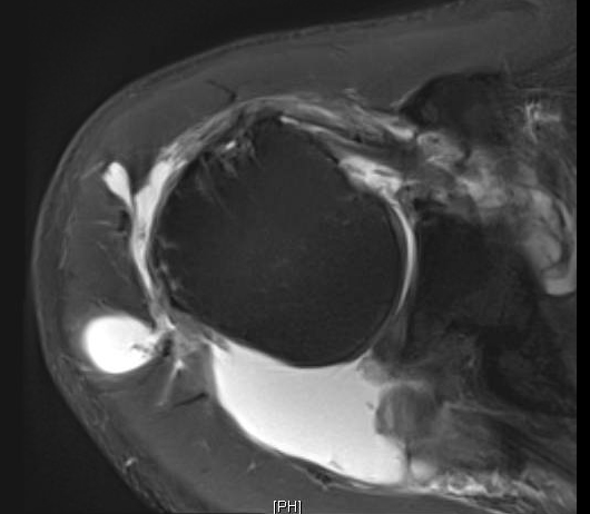 UW Shoulder and Elbow Academy: Exercise treatment for irreparable ...