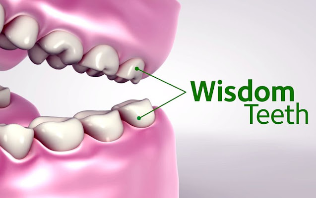 ORAL SURGERY: Get Wise About Wisdom Teeth - ADA