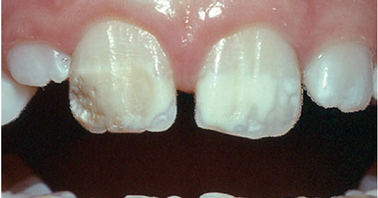 MIH - molar incisor hypomineralization