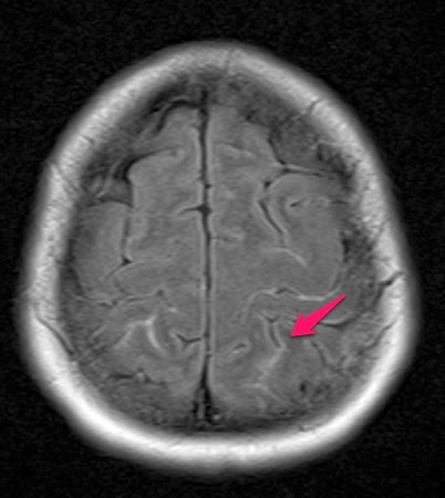 BLOG SCAN - RA Radiologistas Associados: HEMORRAGIA SUBARACNOIDE