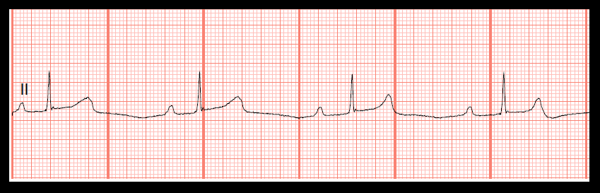 Practice EKG Strips 383