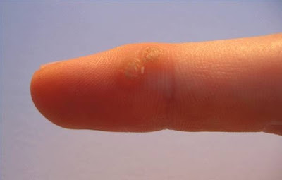 Health and Safety: Common Warts : Causes, Prevention and Home Remedies
