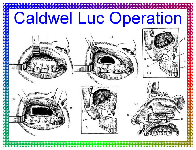 Caldwel luc operation - Sure Developers Team