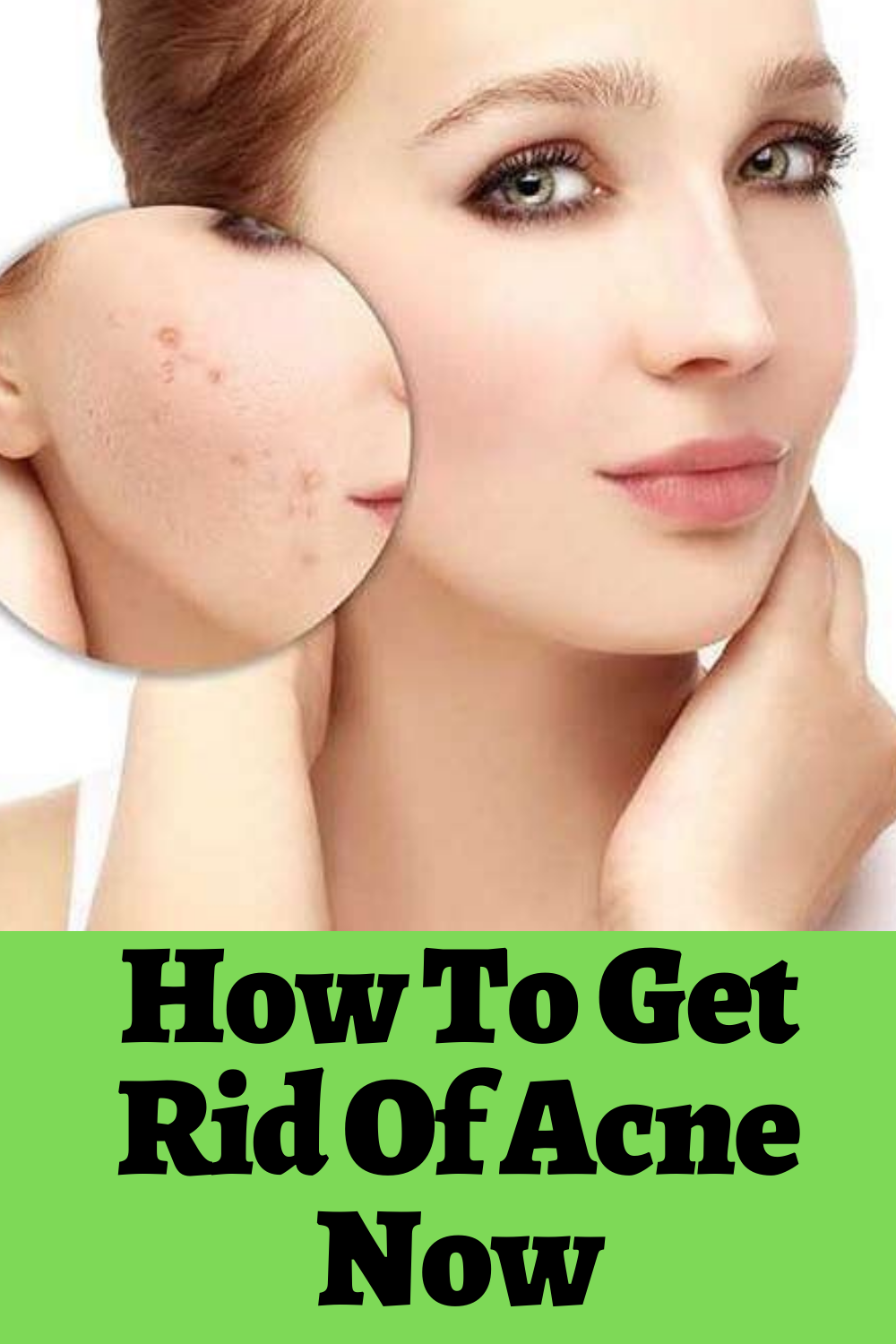 How To Get Rid Of Acne Now how-to-get-rid-of-acne-now