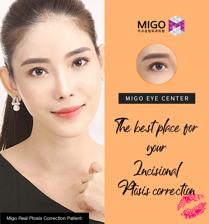 MIGO Eyes | Incisional Ptosis Correction