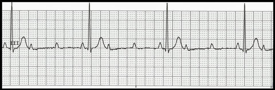 Various 2nd Degree Heart Block Type II various-2nd-degree-heart-block-type-ii