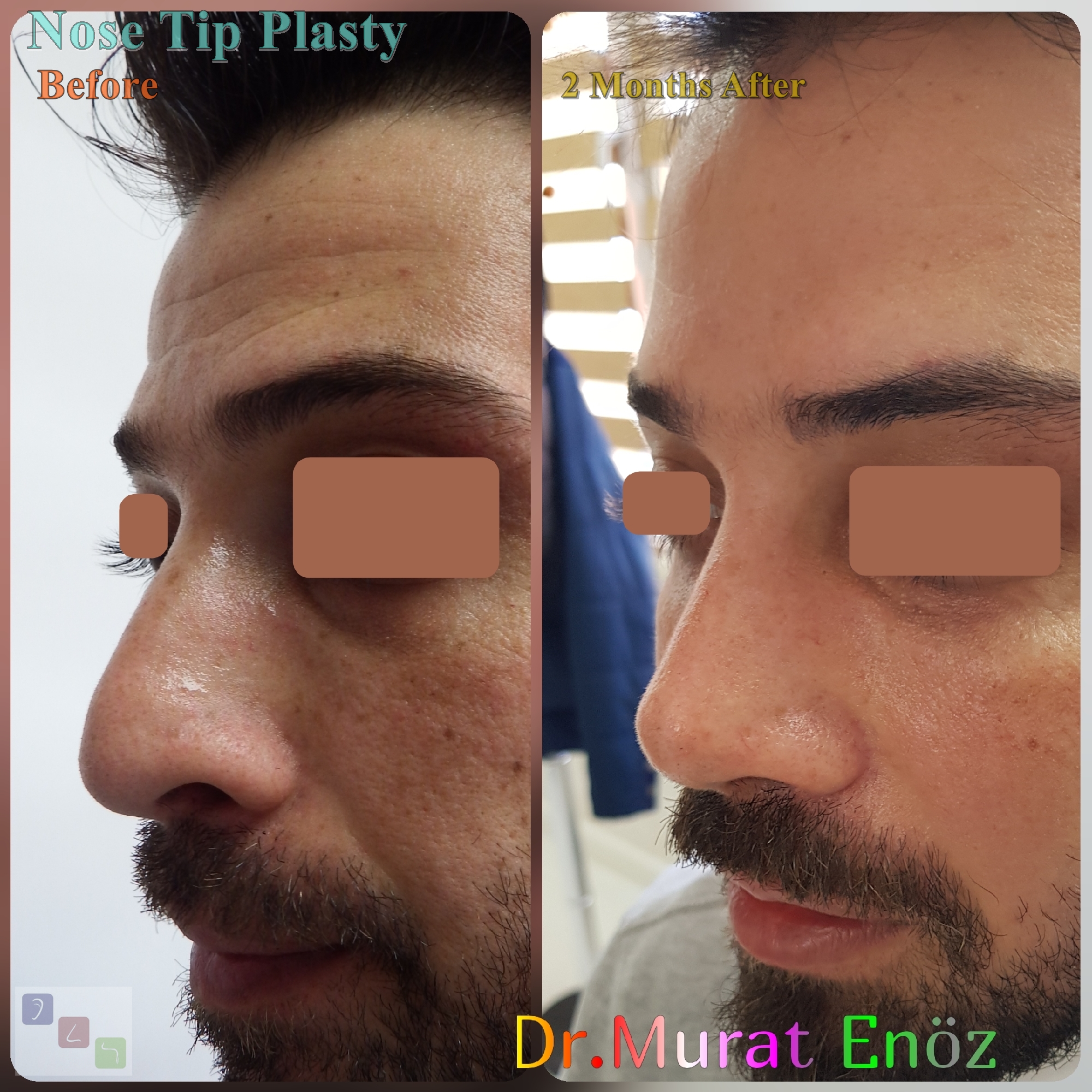 Nasal Tip Plasty and Nose Tip Lifting in Istanbul, Turkey