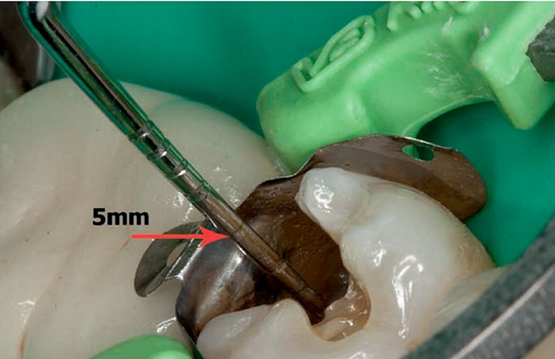 PDF: Class II composite resin restorations: faster, easier, predictable