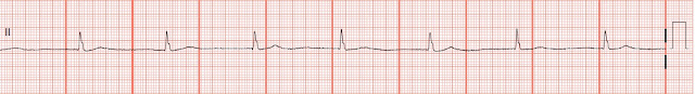 EKG Rhythm Strips 14: Junctional Rhythms
