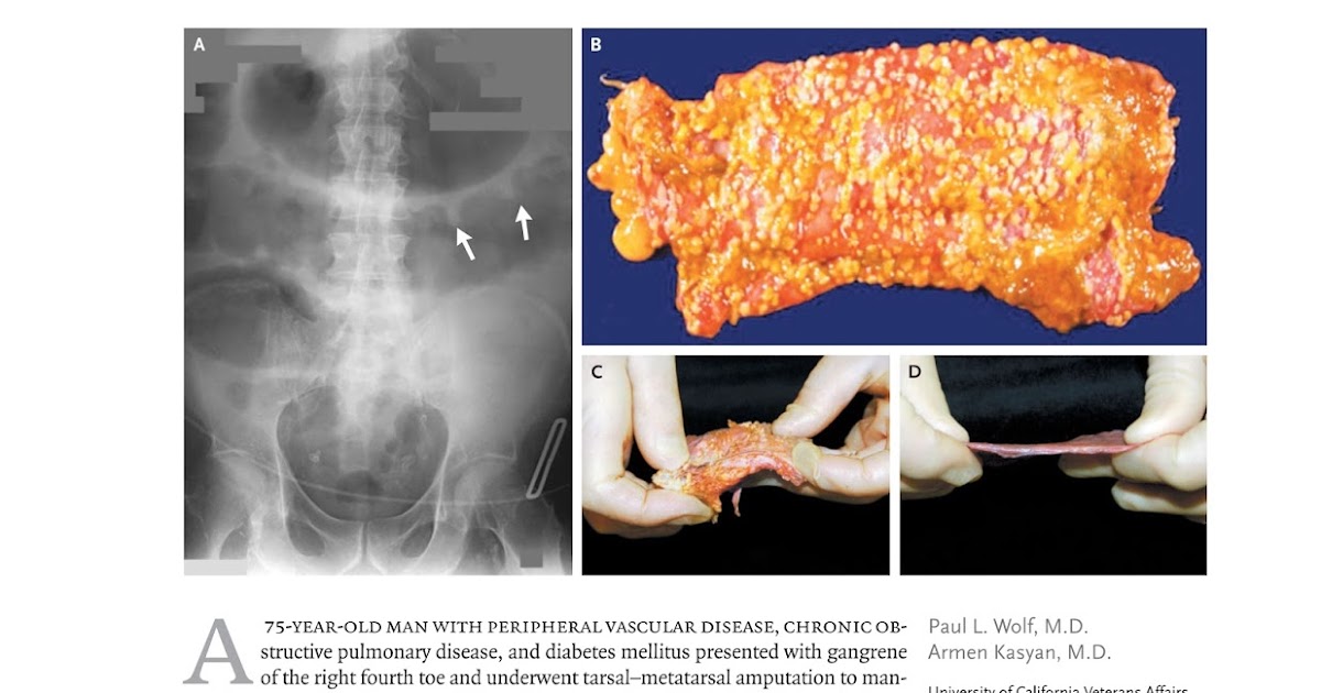 HÌnh Ảnh LÂm SÀng VÀ ChẨn ĐoÁn HÌnh Ảnh Pseudomembranous Colitis Associated With Clostridium