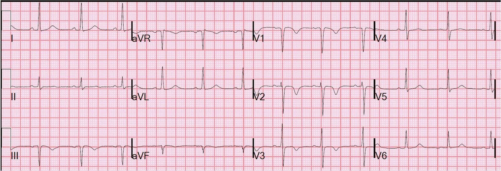 Dr. Smith's ECG Blog: Chest pain and LBBB. LBBB resolves and there is ...