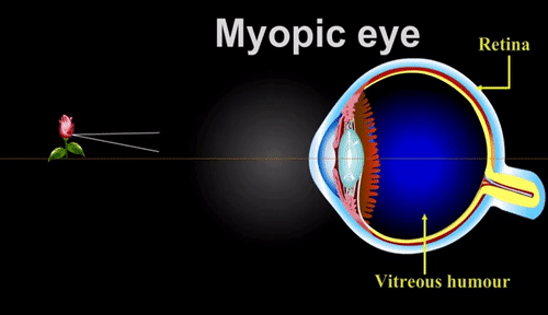 ANATOMÍA: MIOPÍA