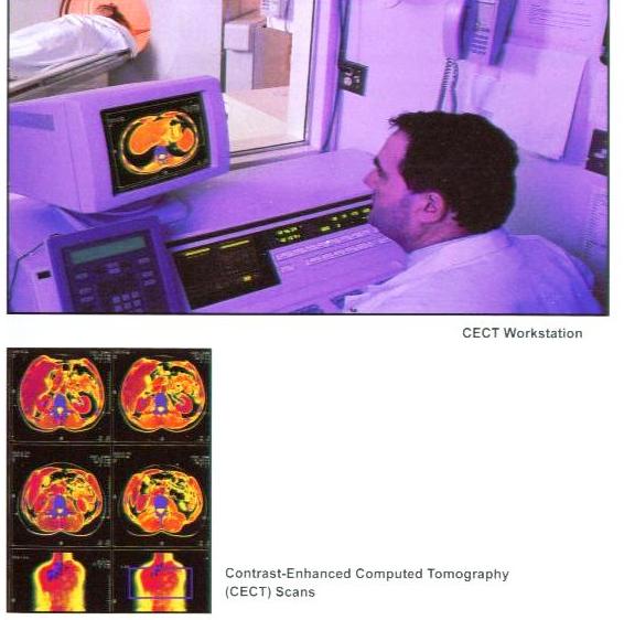jm's Adventure with Multiple Myeloma: Intravenous Access Port - Bard ...