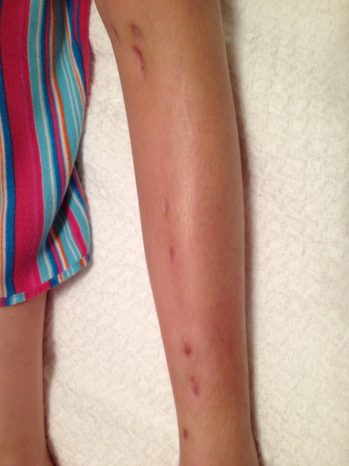 fibular hemimelia leg lengthening: 2012