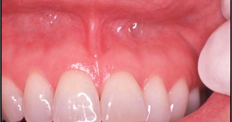 Nathanael Busby: All About the Frenum and types of it