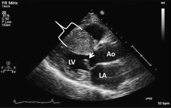 Hypertrophic Cardiomyopathy Case File