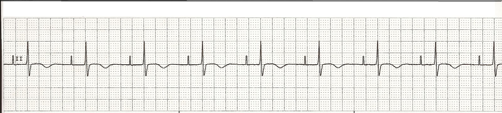 EKG Rhythm Strips 48