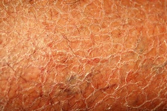 AMATI IN TUTTO: PELLE SECCA spiegazione e rimedi