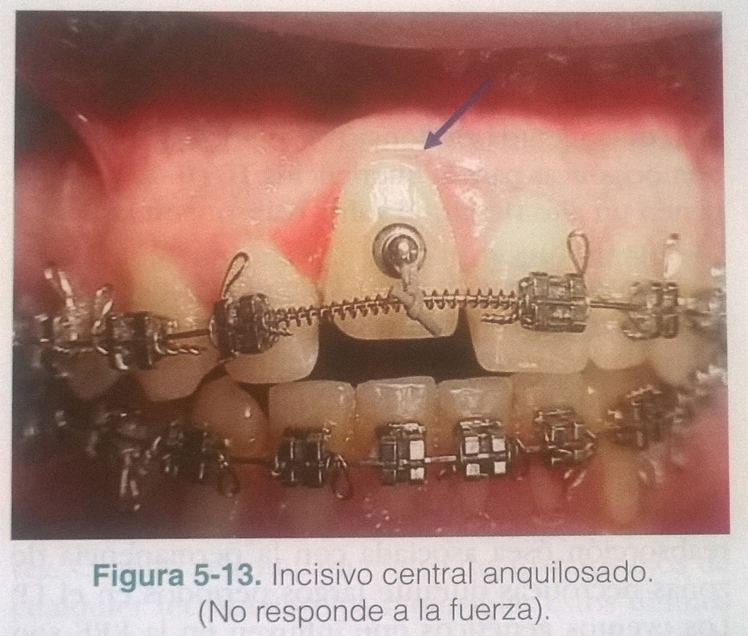 Tu Ortodoncia.: REABSORCION RADICULAR