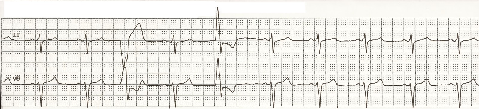 EKG Rhythm Strips 18: Ventricular Ectopy 1