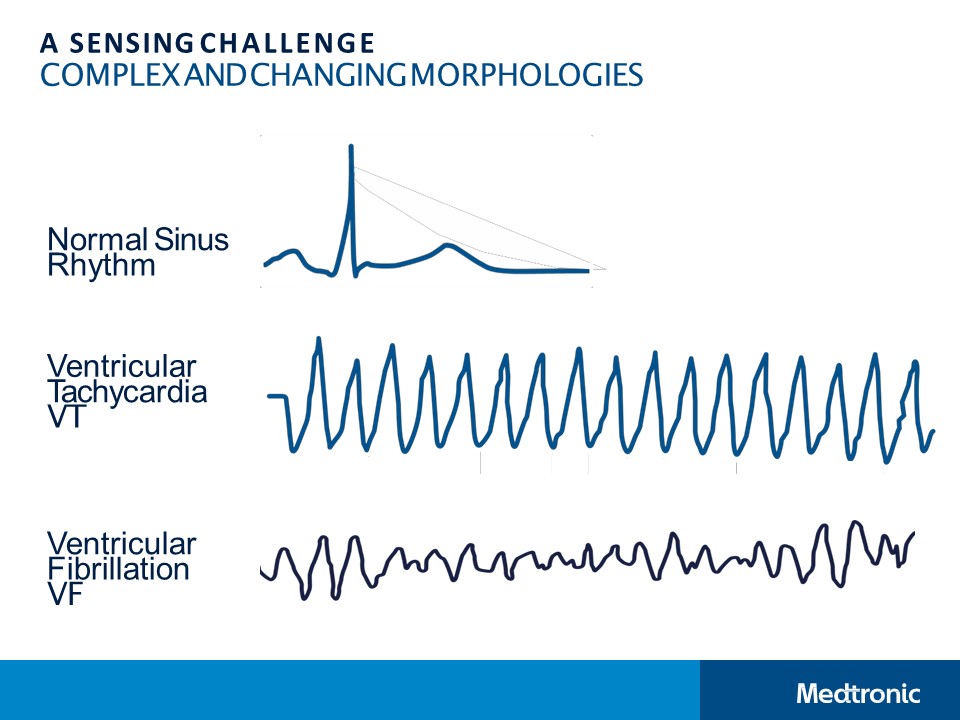 CVT Mohd Farid: Concept Of ICD Technology-Sensing & Detection-Medtronic ...