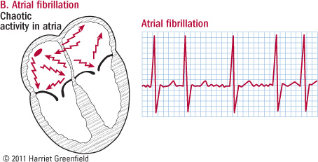 Medicamentum: Atrial Fibrillation Part One - Definition