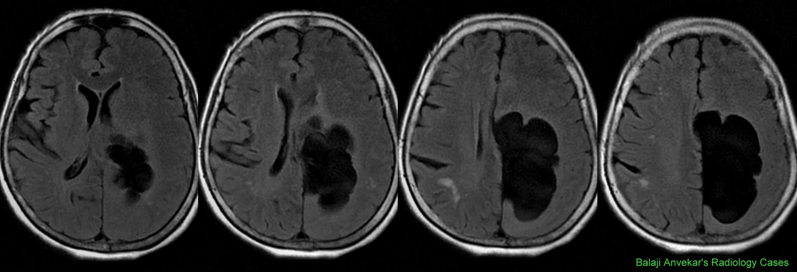 Dr Balaji Anvekar FRCR: Interhemispheric cyst without corpus callosal ...