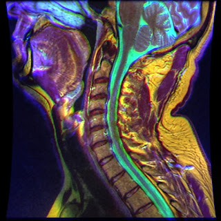 Nevit's blog: Color MRI of the Cervical Spine