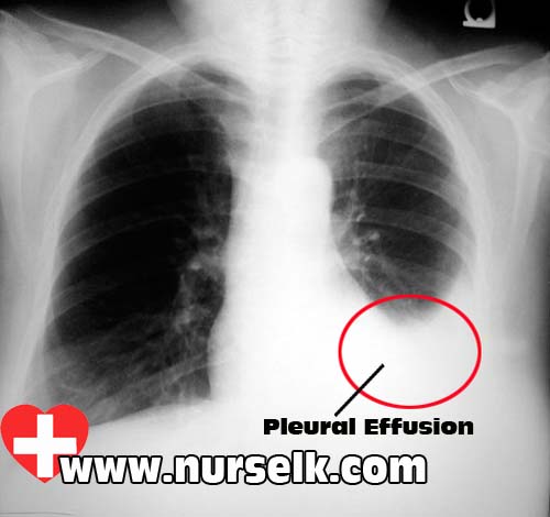 Pleural Effusion | Nurselk.com