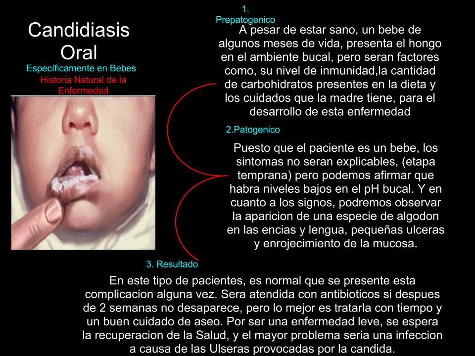 Los mejores alumnos del mundo: Candidiasis Oral en bebes