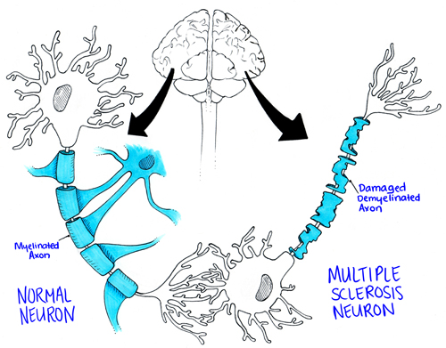 Multiple sclerosis and nutrition guidelines: Multiple sclerosis and ...