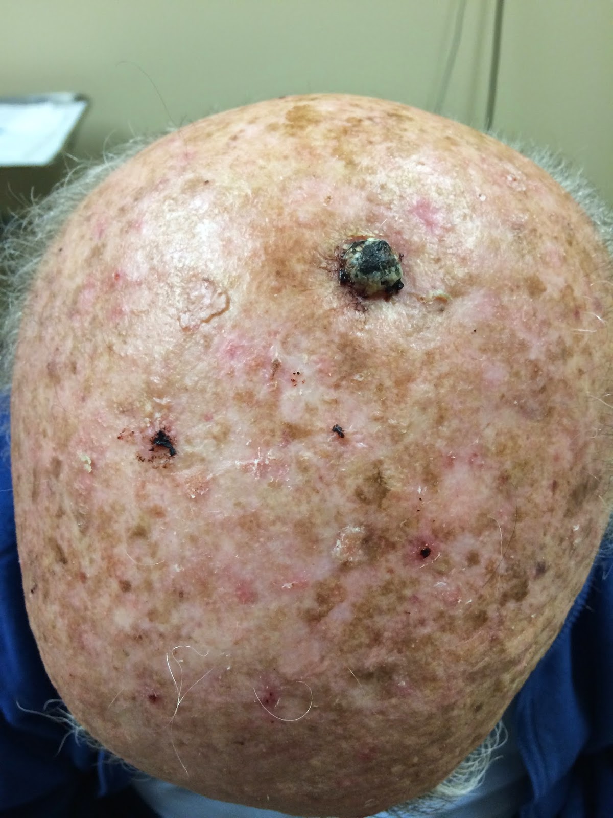 What is meant by “pre-skin cancer”? Actinic keratosis